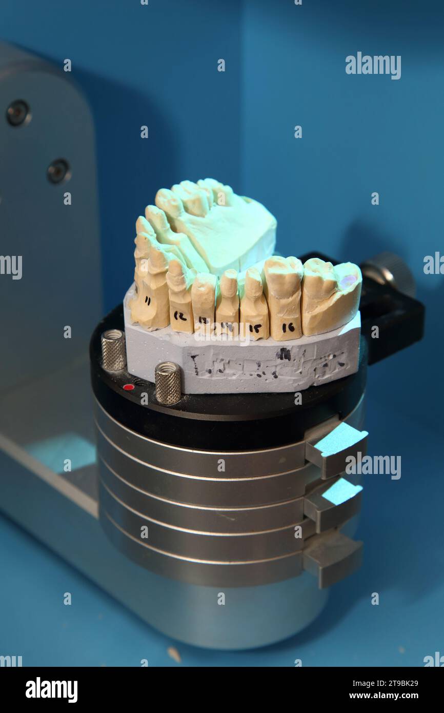 Fabrication of dental crowns and dentures made of ceramic. Scanning of plaster casts of teeth ...