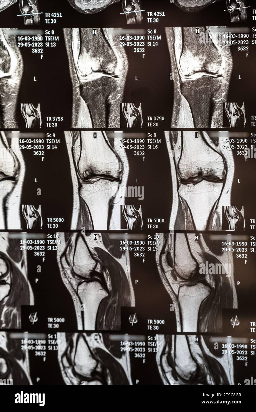 Magnetic resonance imaging of human knee joint for medical diagnosis ...