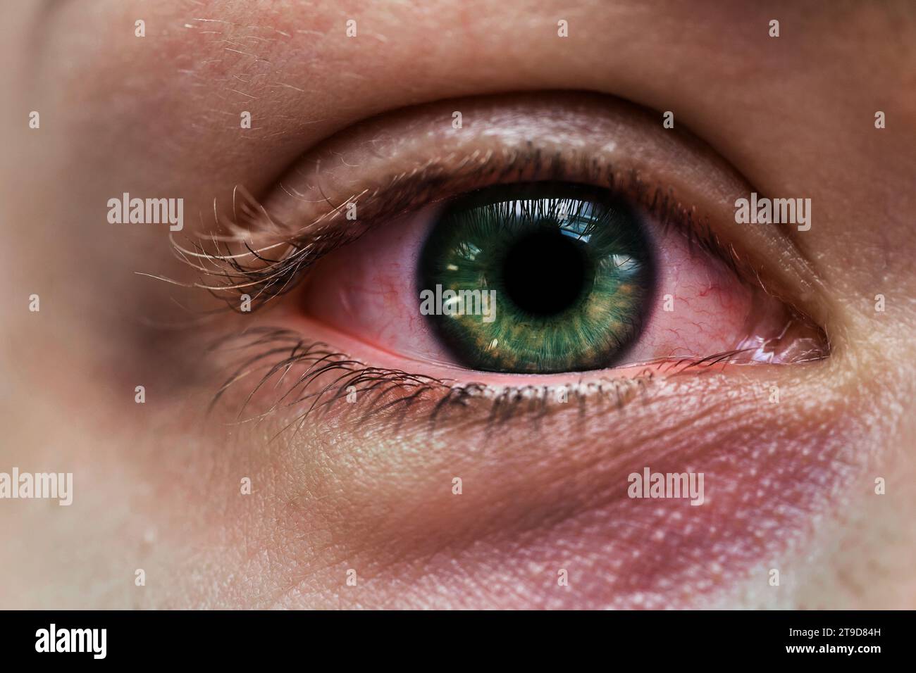 Closeup of infected female eye with a green iris and subconjunctival ...