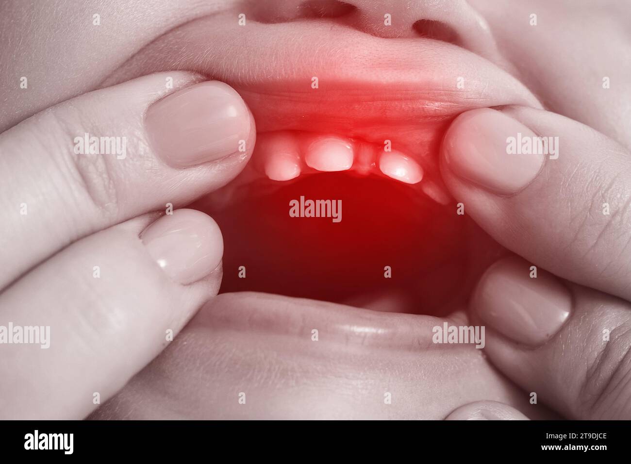 Symptoms of teething hi-res stock photography and images - Alamy