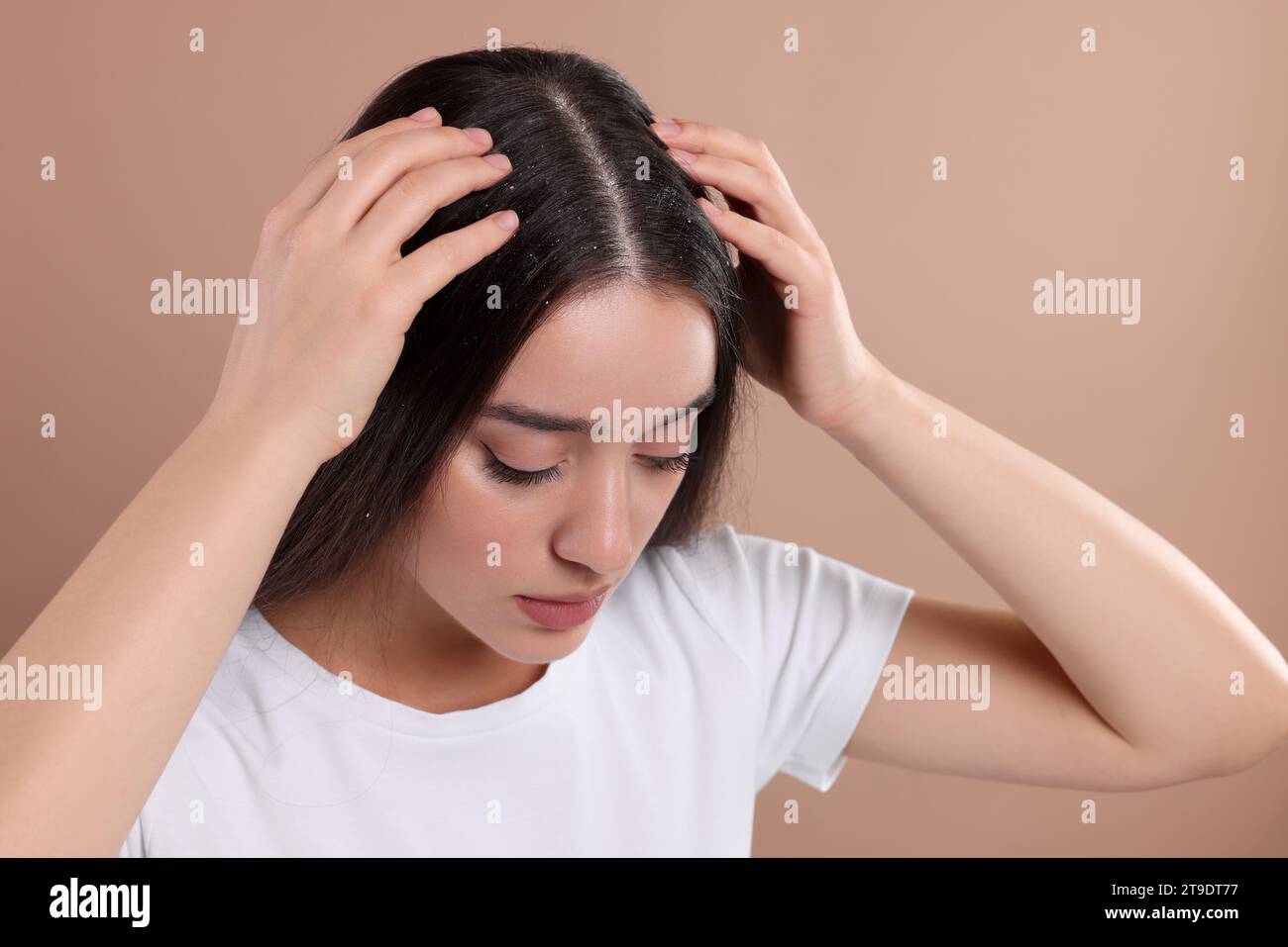 Woman suffering from dandruff problem on beige background Stock Photo ...