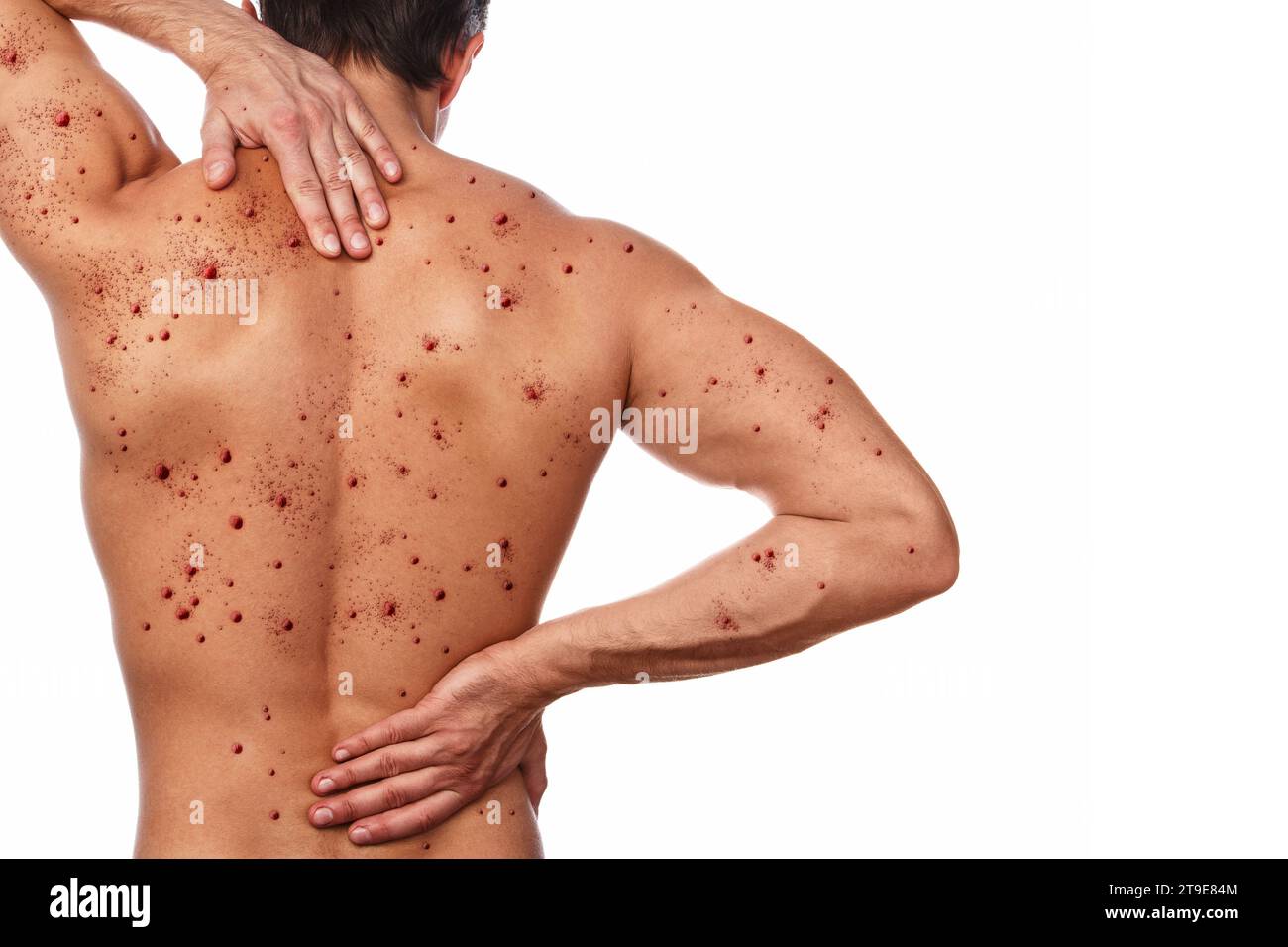 Male back affected by blistering rash because of monkeypox or other ...