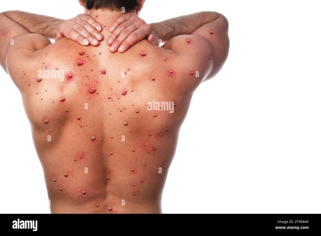 Male back affected by blistering rash because of monkeypox or other ...