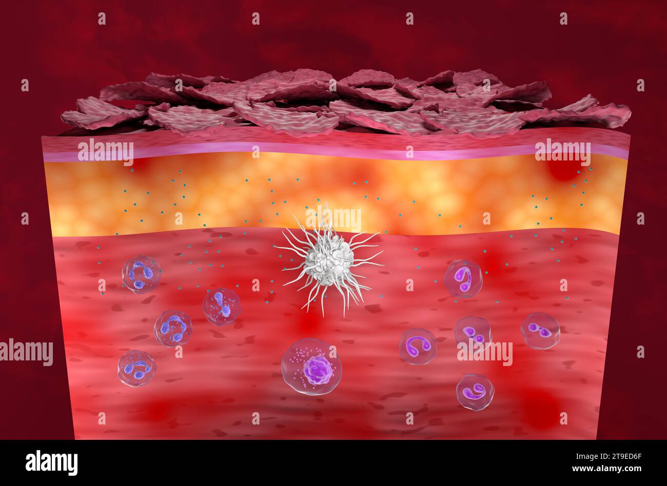 Inflammatory Skin In Eczema Atopic Dermatitis Ad Isometric View 3d