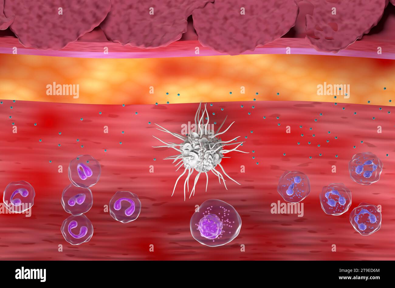 Inflammatory skin in Eczema, Atopic Dermatitis (AD) - top view 3d ...