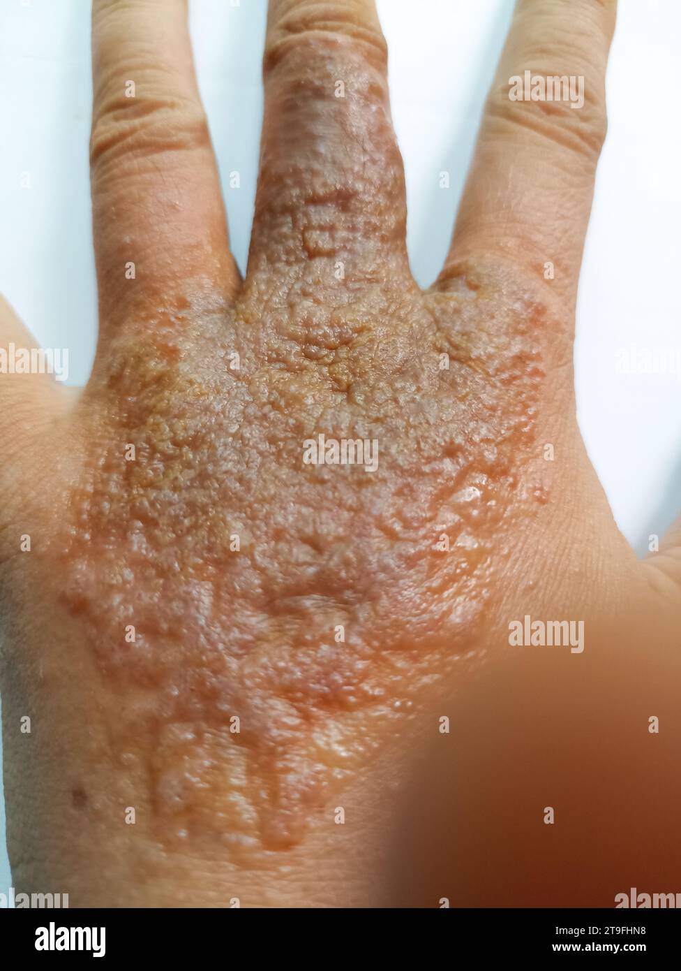 rash eczema dermatitis on hand. inflammation of skin Stock Photo - Alamy