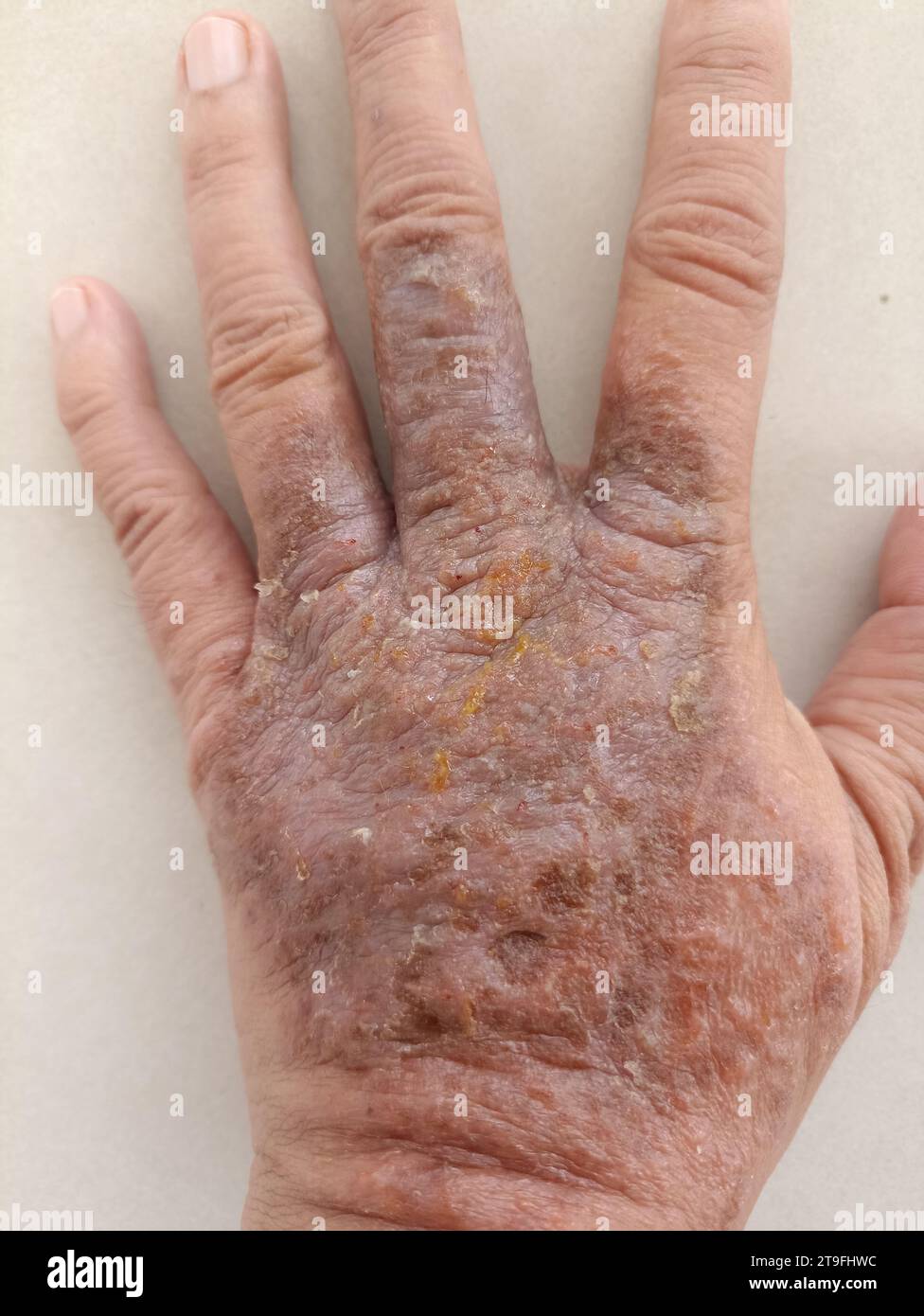 rash eczema dermatitis on hand. inflammation of skin Stock Photo - Alamy
