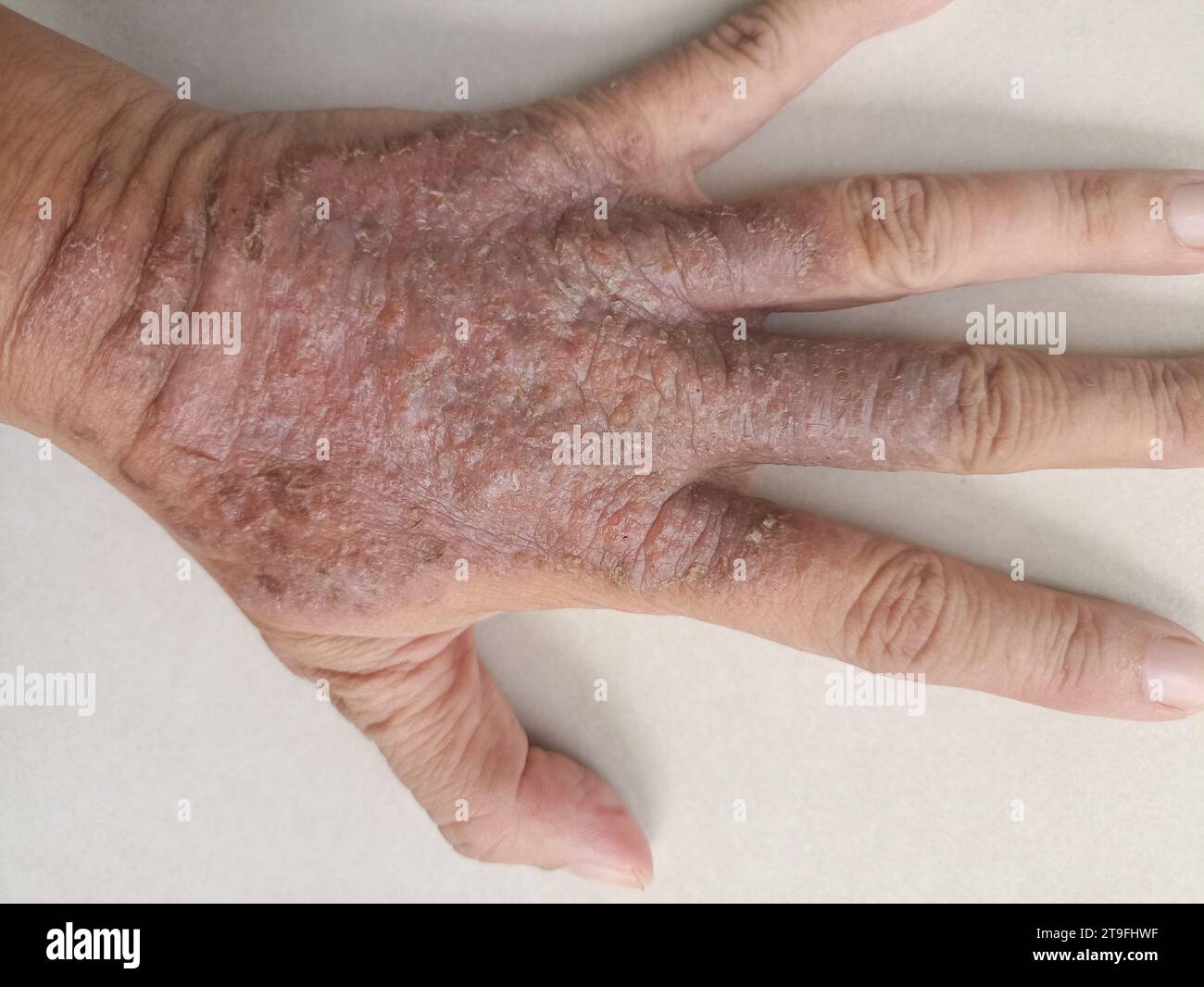 rash eczema dermatitis on hand. inflammation of skin Stock Photo - Alamy