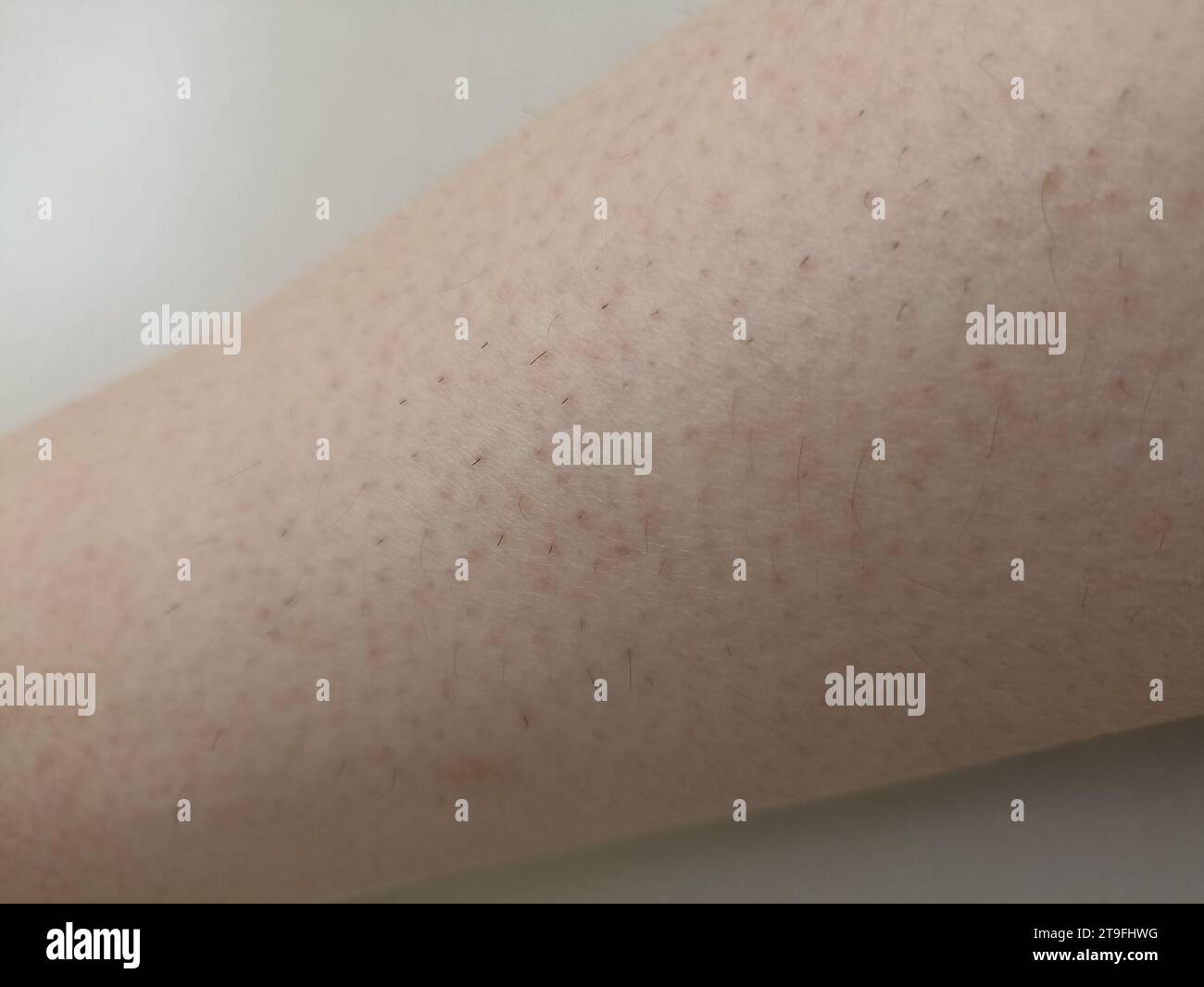 rash eczema dermatitis on leg. inflammation of skin Stock Photo - Alamy