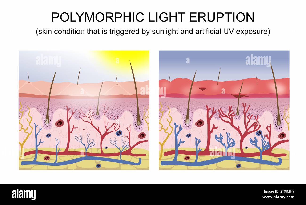 Polymorphic light eruption Illustration comparison Stock Photo - Alamy