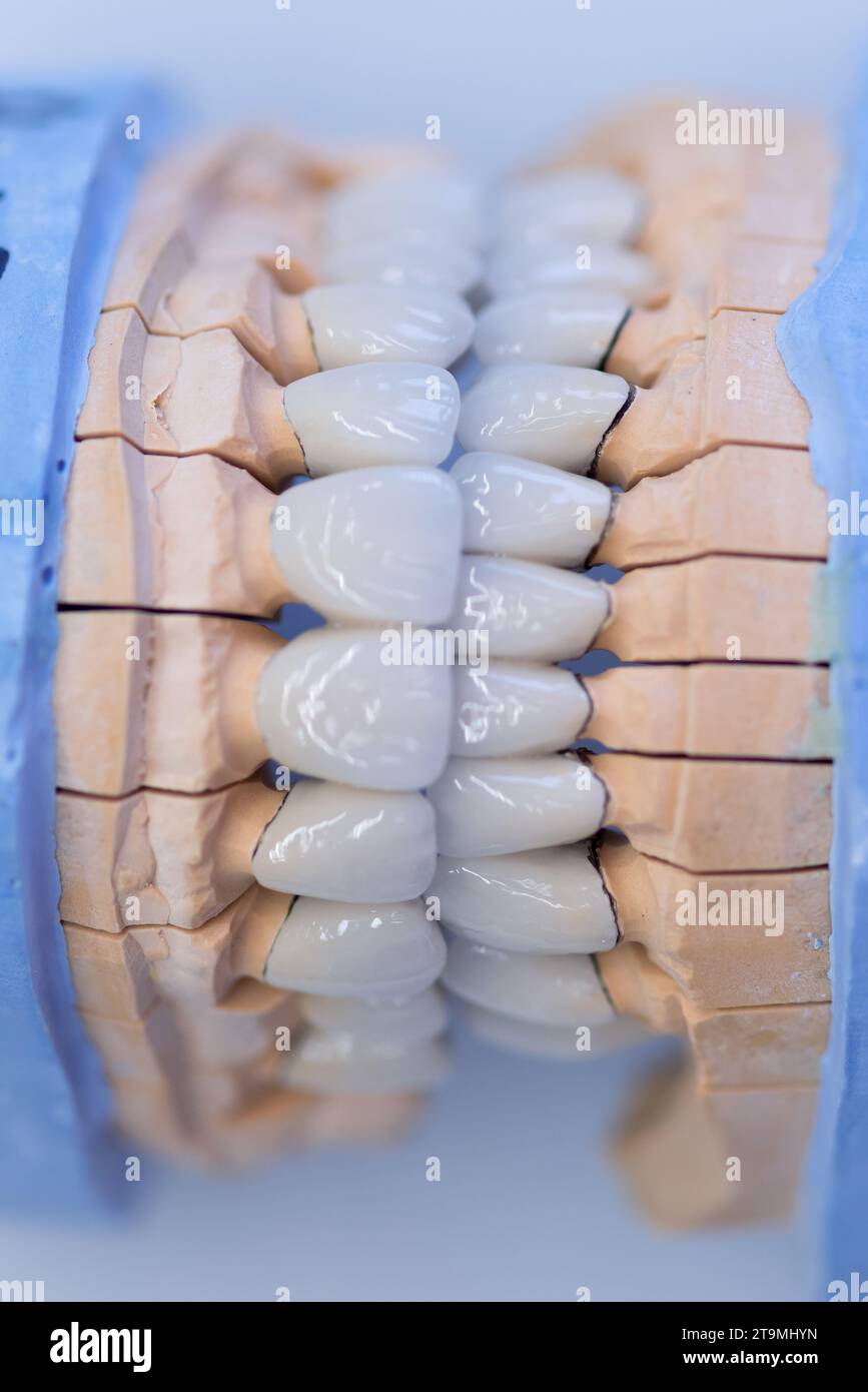 Dental teeth dentists model. Models of human jaws in an orthodontic ...