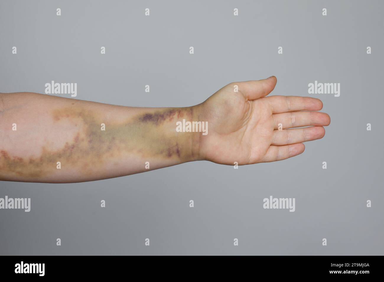 Hand with bruise close up on gray background Stock Photo - Alamy