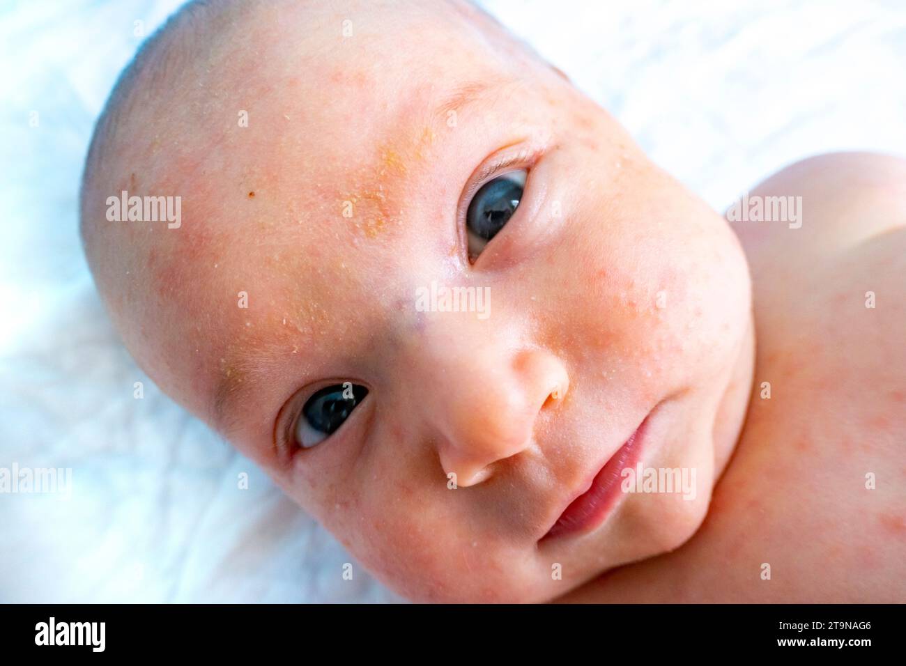 Baby Skin Rash Milia at Hugo Trickett blog
