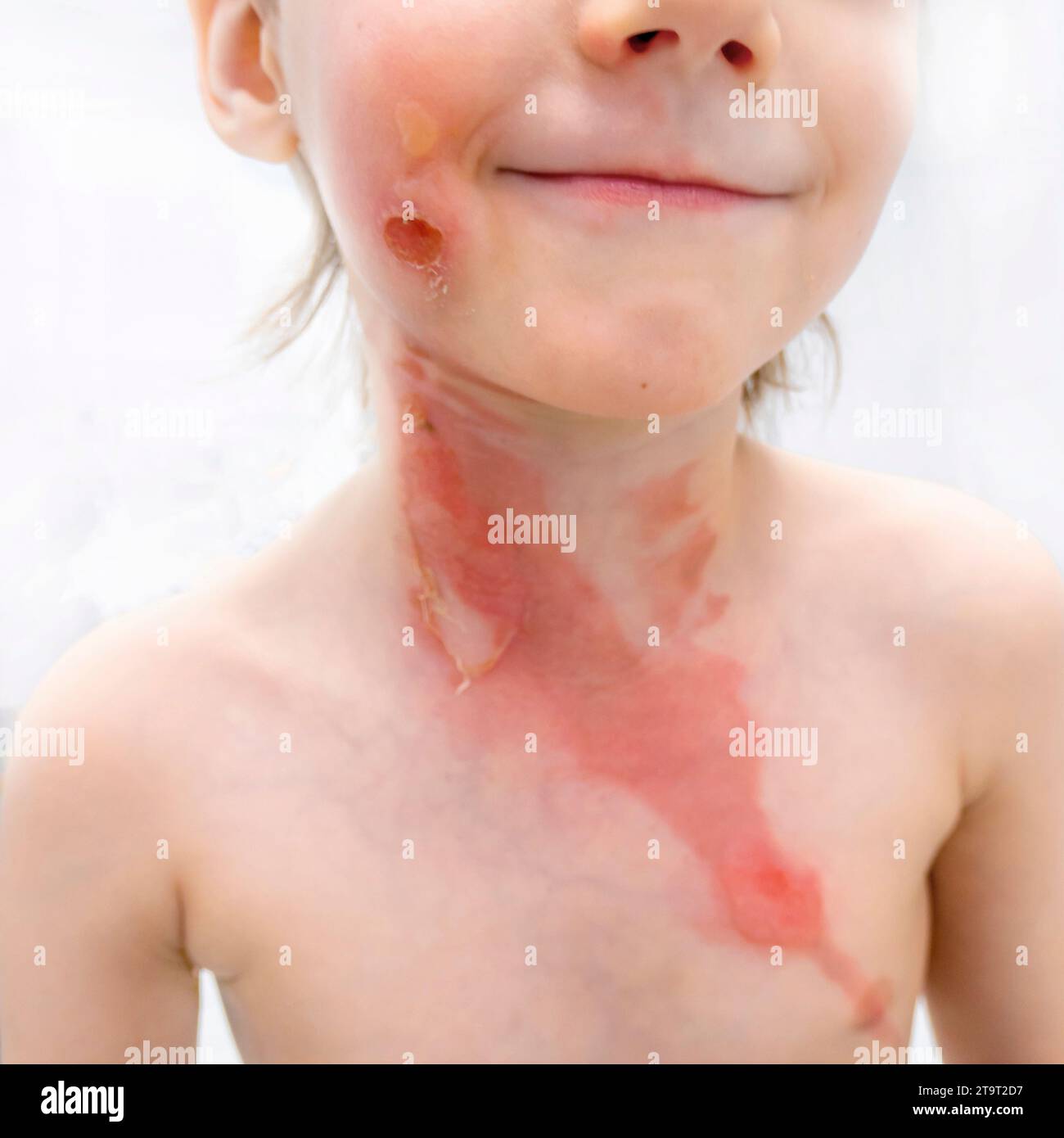 dressing a boy with a burn from boiling water Stock Photo - Alamy