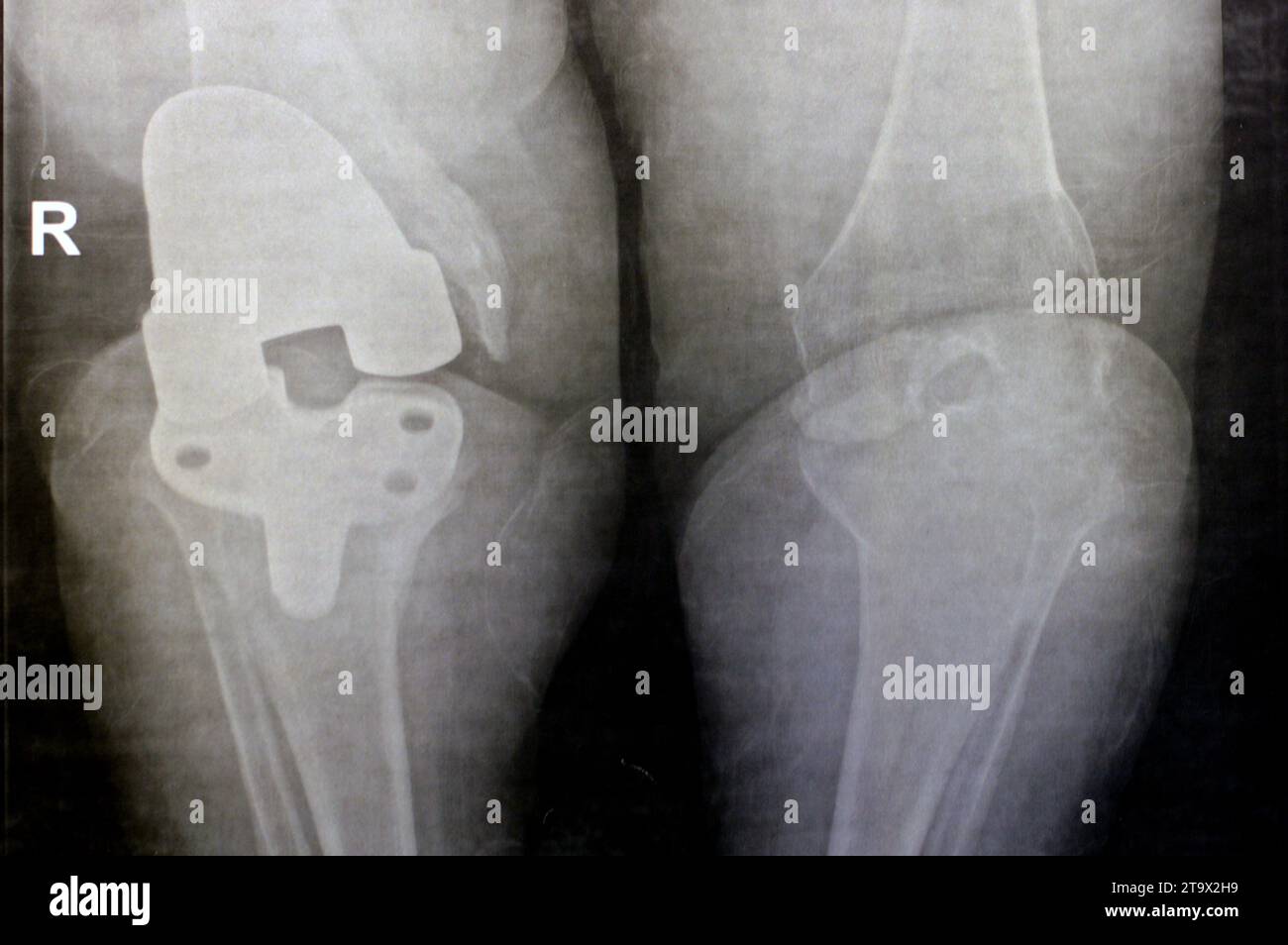 Plain X-ray of knee joints, right side shows total knee replacement ...