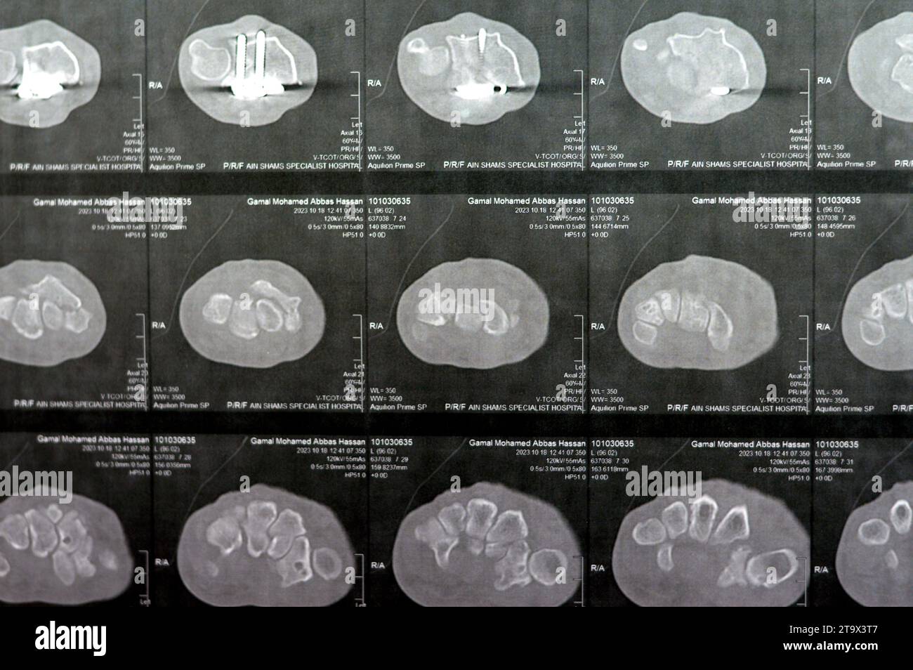 Cairo, Egypt, October 18 2023: CT scan left wrist joint showing a ...