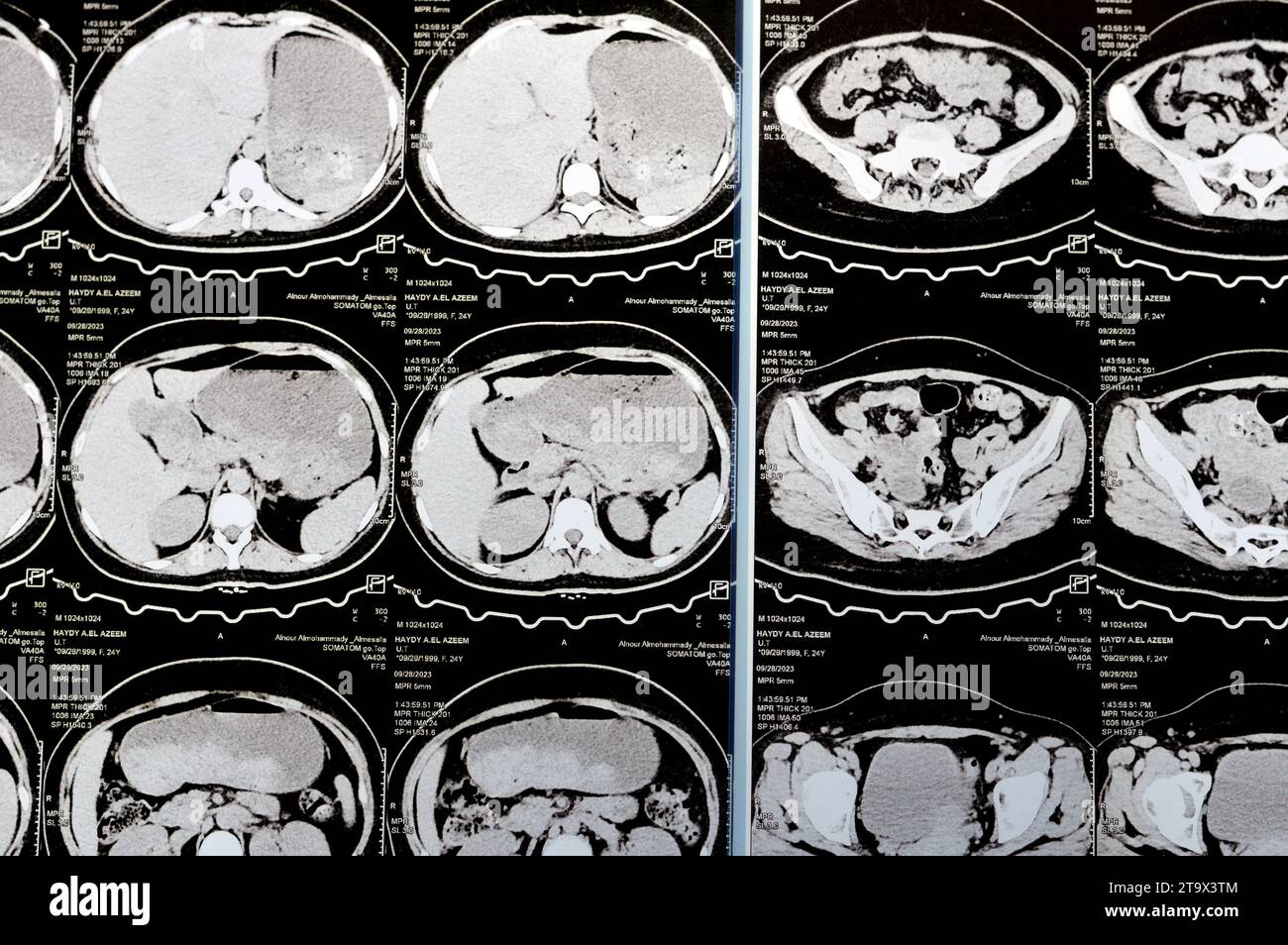 Cairo, Egypt, October 3 2023: Multi slice CT scan abdomen and pelvis ...
