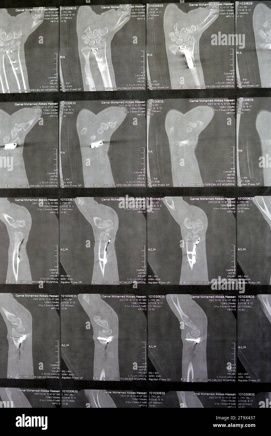 Cairo, Egypt, October 18 2023: CT scan left wrist joint showing a ...