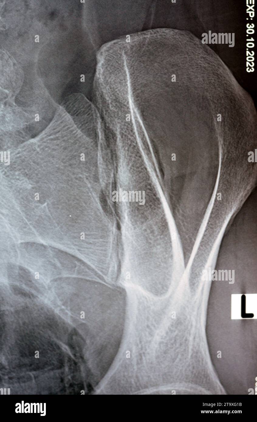 Sacroiliac joint digital radiograph examination X-ray reveals preserved ...