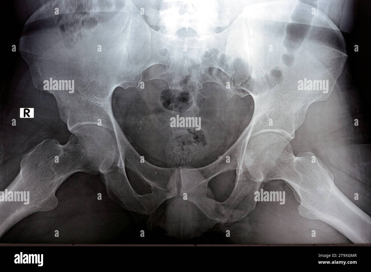 Hip joints digital radiographic examination reveals normal appearance ...