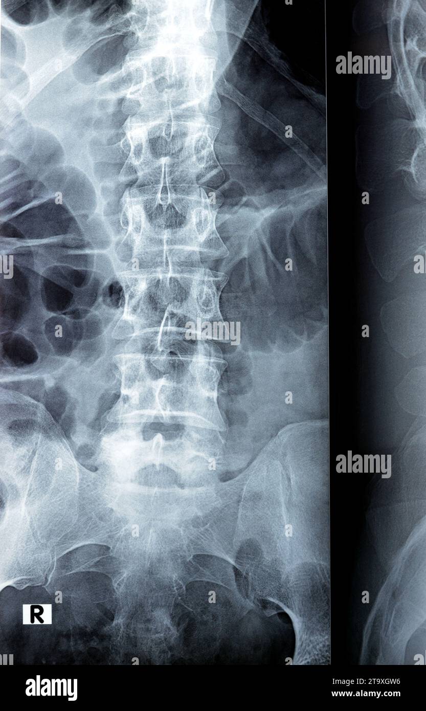 Lumbosacral spine digital radiographic examination reveals straightened ...