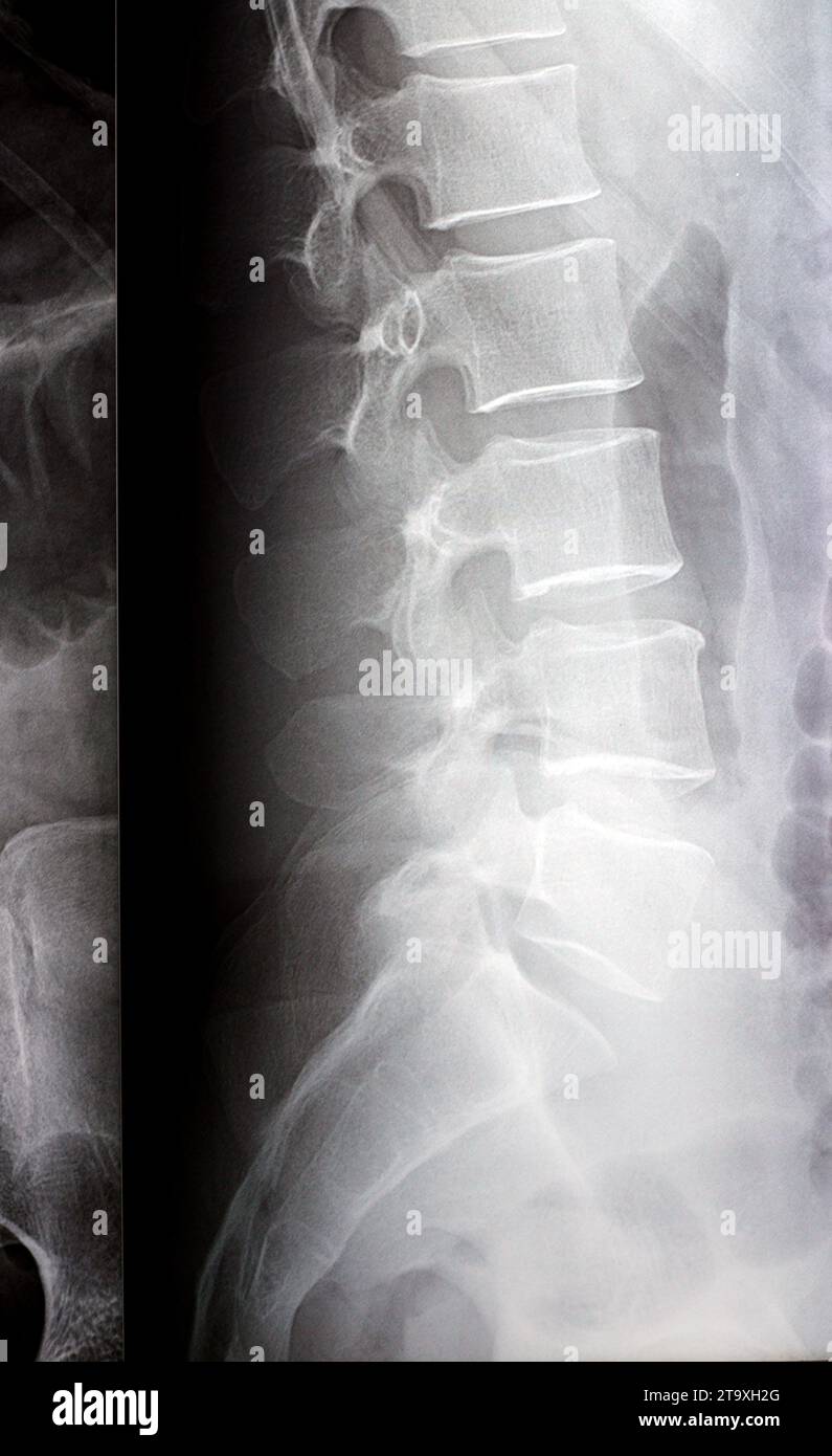 Lumbosacral spine digital radiographic examination reveals straightened ...