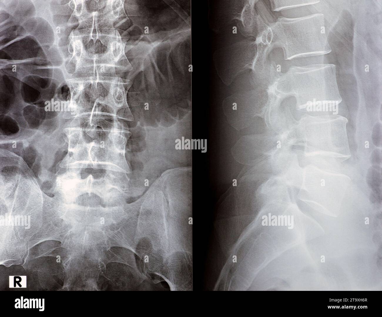 Lumbosacral spine digital radiographic examination reveals straightened ...