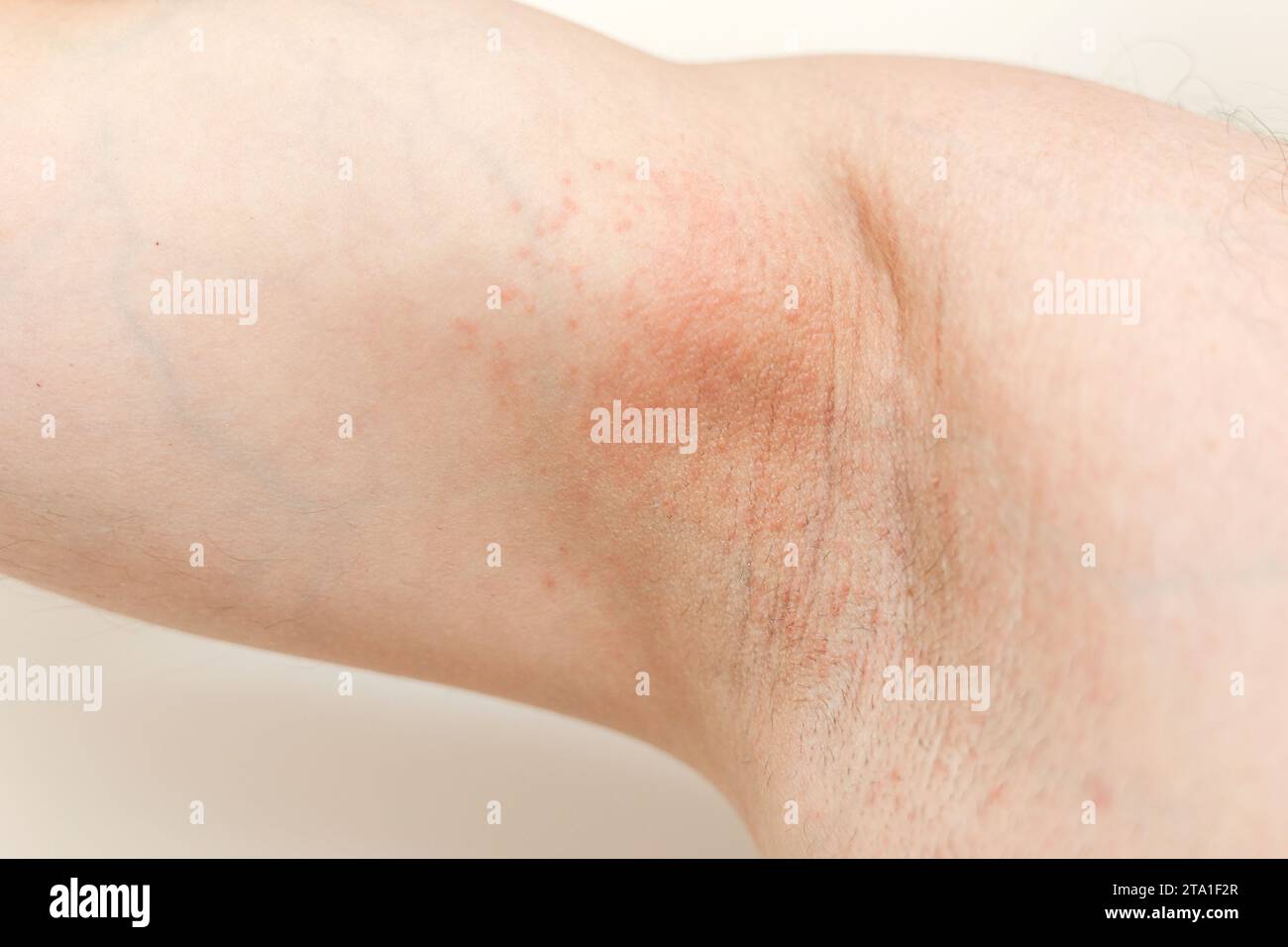 Allergy underarm. Cropped photo of irritation, inflammation on the ...