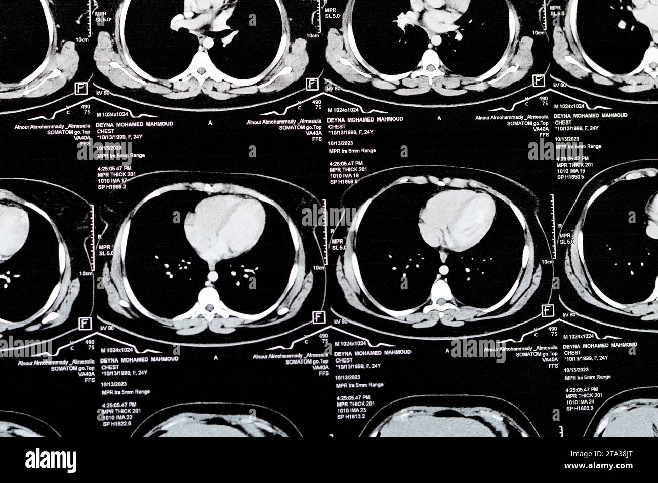 Cairo Egypt October 15 2023 Ct Scan Axial Slices Through Chest With Contrast Injection
