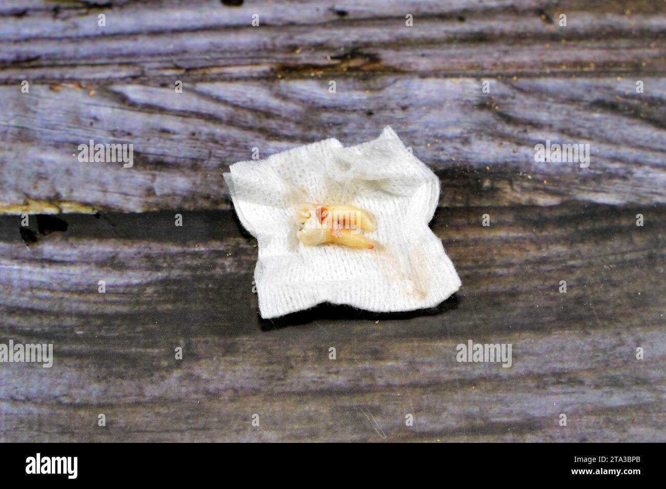 Extracted wisdom 8th lower right tooth with a teeth decay, after ...