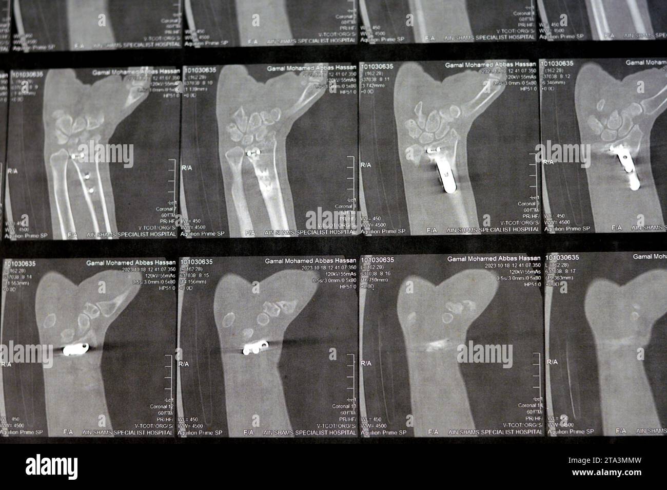 Ct wrist joint hi-res stock photography and images - Alamy