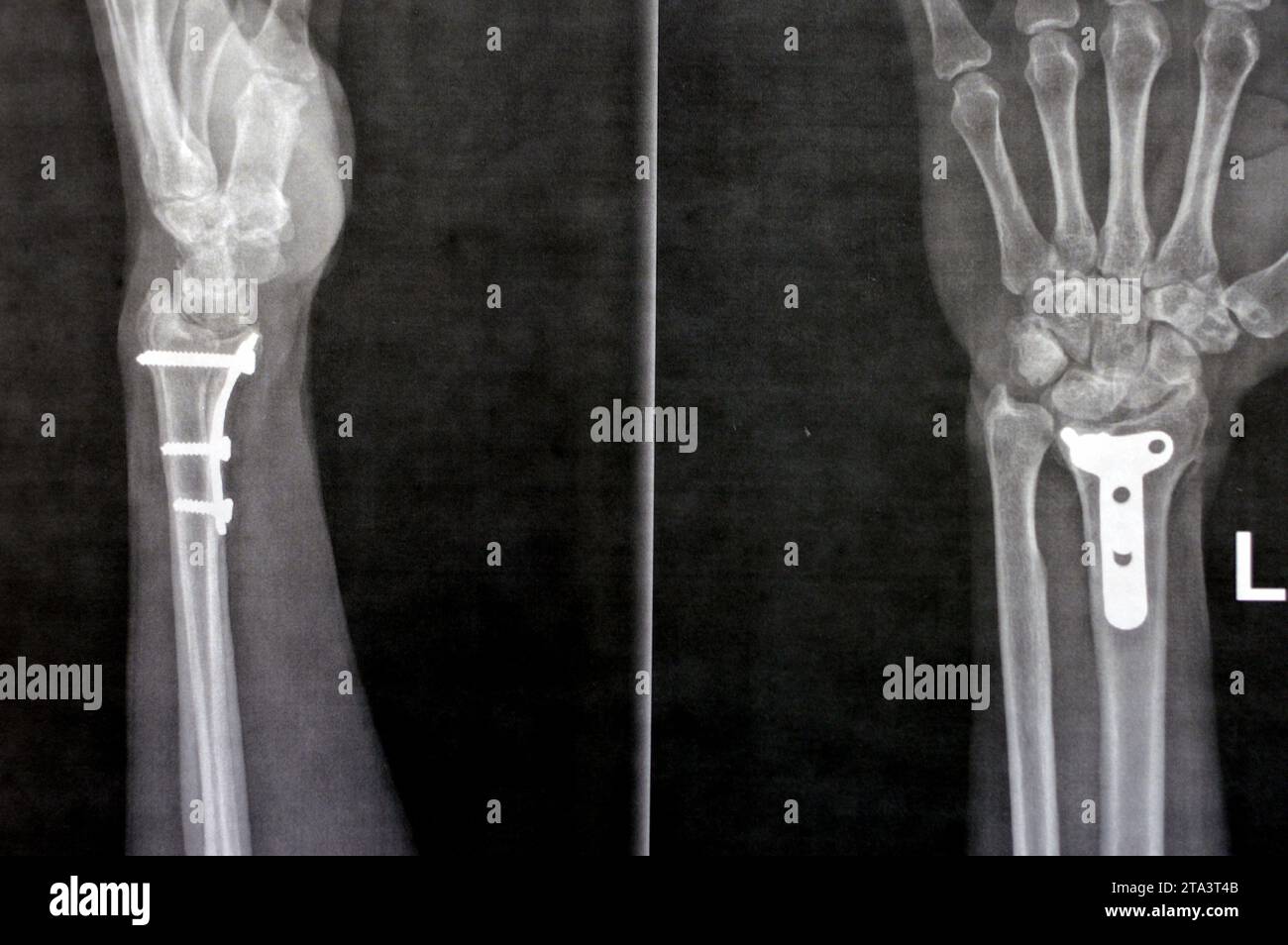 Plain x ray showing a recent fissure fracture at the lower part of a ...