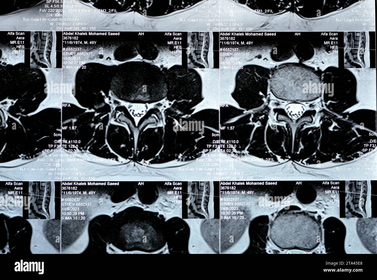 Cairo, Egypt, November 14 2023: MRI of lumbosacral spine revealed L3-L4 ...