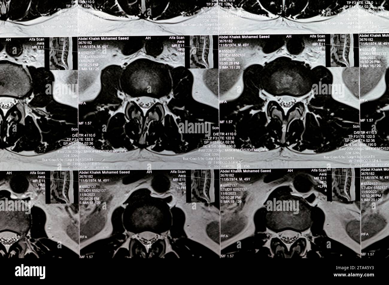 Cairo, Egypt, November 14 2023: MRI of lumbosacral spine revealed L3-L4 ...