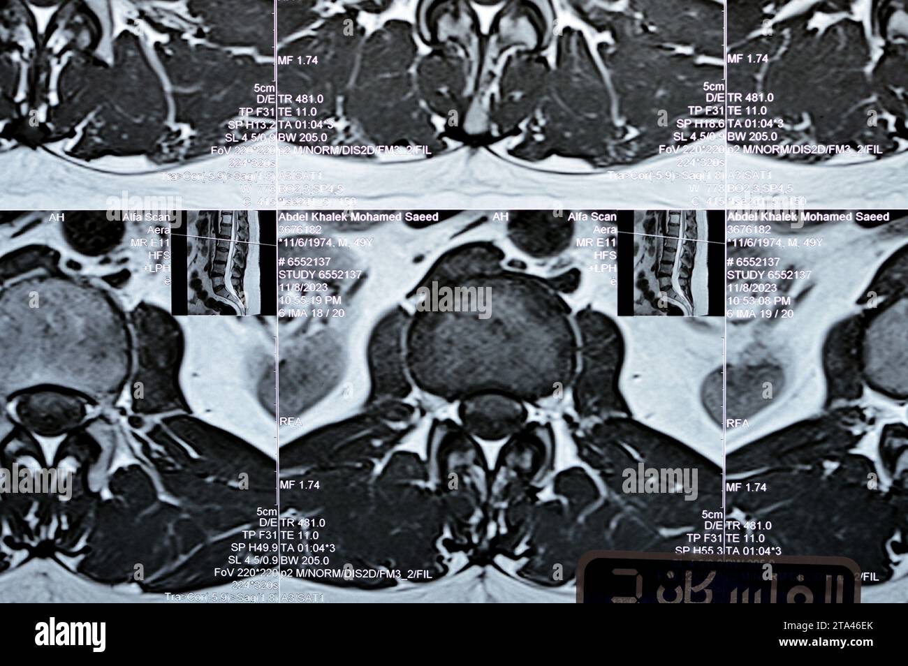 Cairo, Egypt, November 14 2023: MRI of lumbosacral spine revealed L3-L4, L4-L5 posterior disc ...