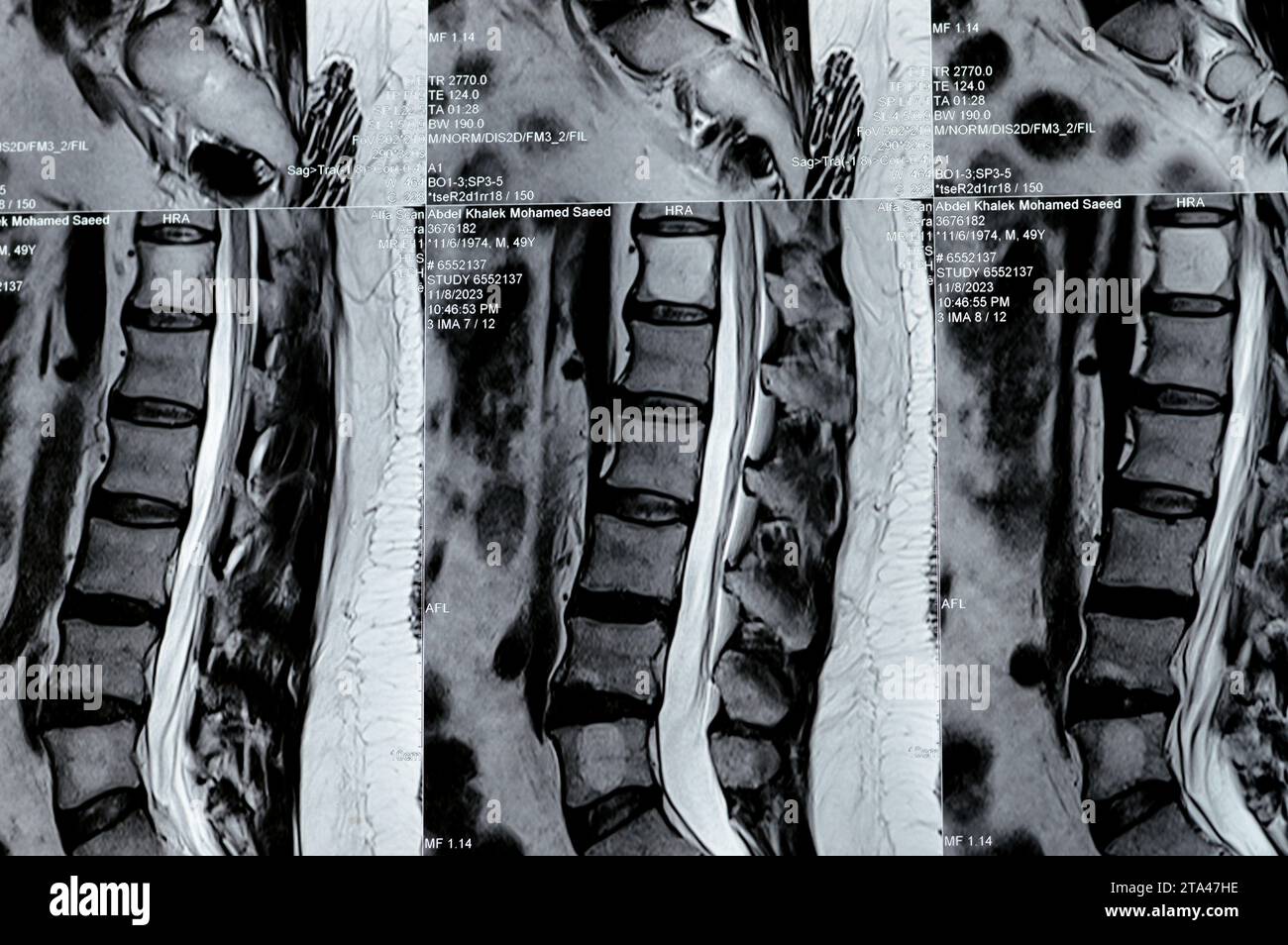 Cairo, Egypt, November 14 2023: MRI of lumbosacral spine revealed L3-L4, L4-L5 posterior disc ...