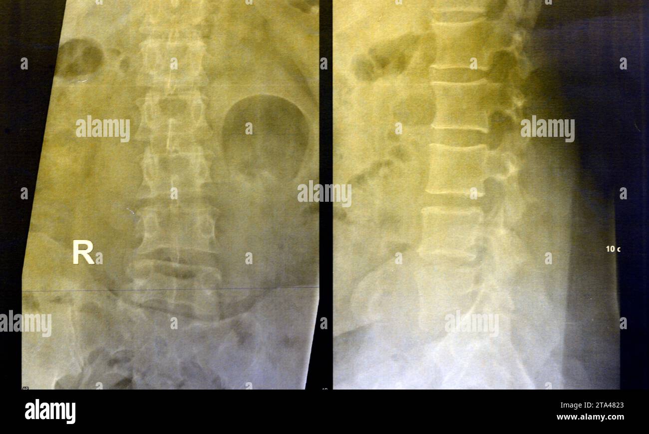 Plain X ray lumbosacral spine revealed straightened, mild scoliotic ...
