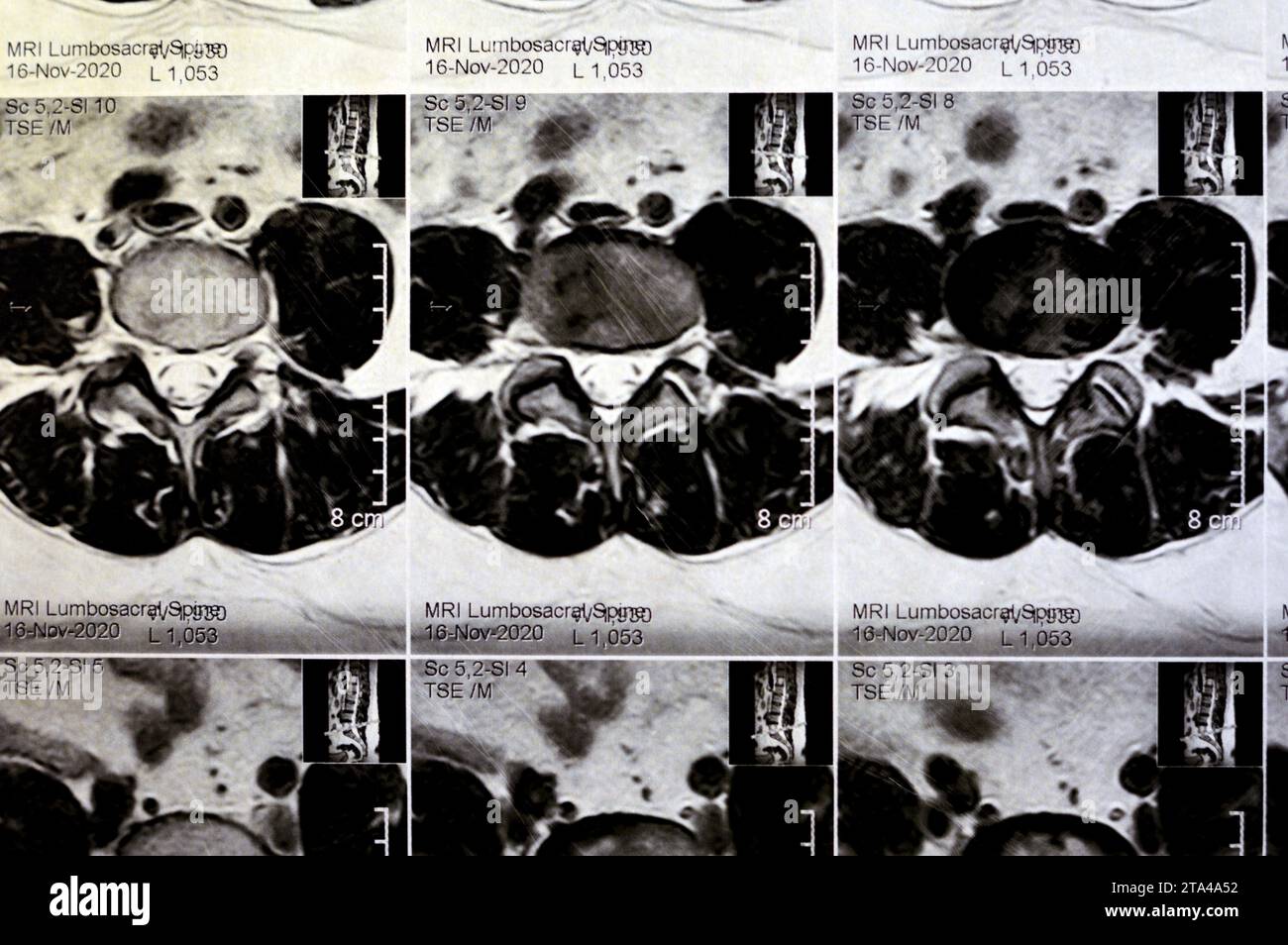 Mri Lumbosacral Spine Without Contrast Revealed Back Muscle Spasm Mild