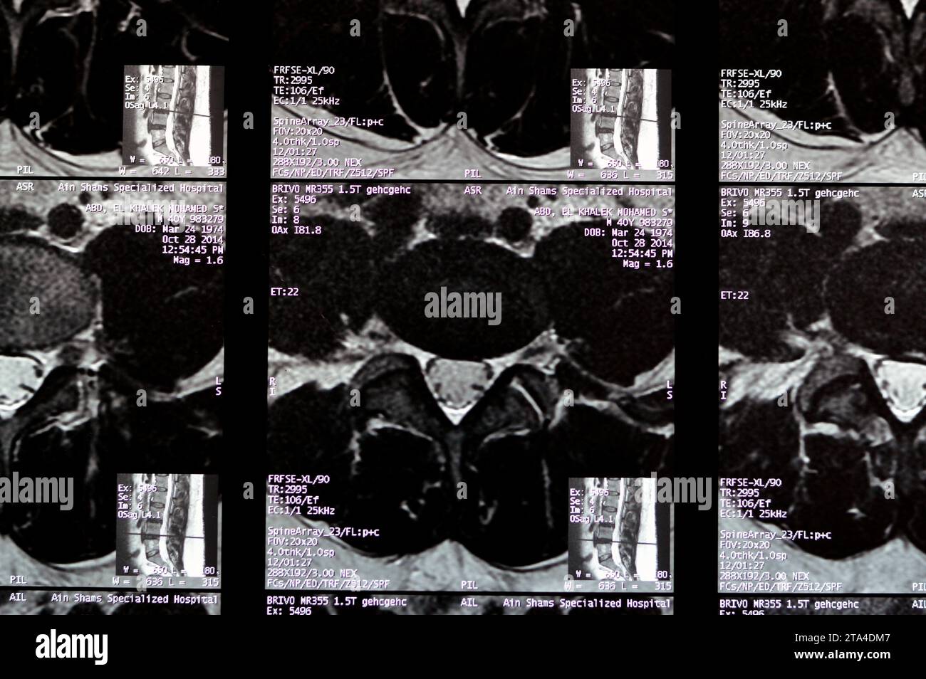 Cairo, Egypt, November 14 2023: MRI of lumbosacral spine revealed ...