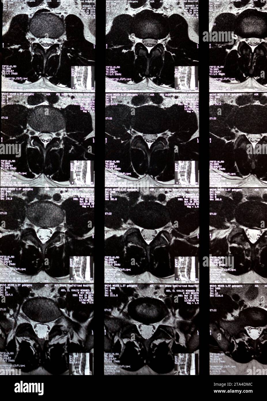Cairo, Egypt, November 14 2023: MRI of lumbosacral spine revealed ...