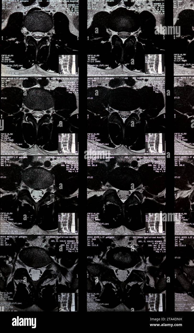 Cairo, Egypt, November 14 2023: MRI of lumbosacral spine revealed ...