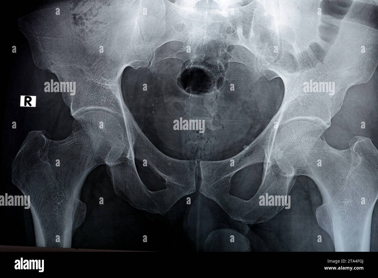 Hip joints digital radiographic examination reveals normal appearance ...