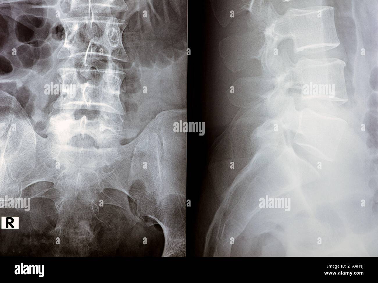 Lumbosacral spine digital radiographic examination reveals straightened ...