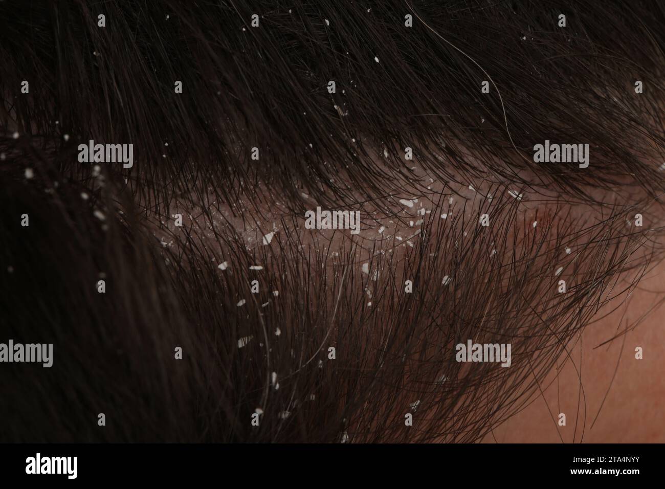 Man with dandruff hi-res stock photography and images - Alamy