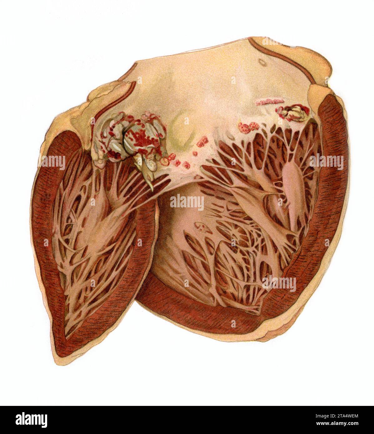 Heart valve infection, illustration Stock Photo - Alamy