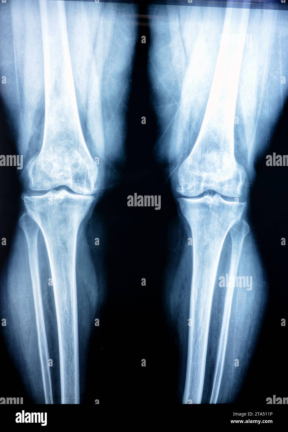 Plain X ray of both knee joints shows apparent joint osteoarthritis ...