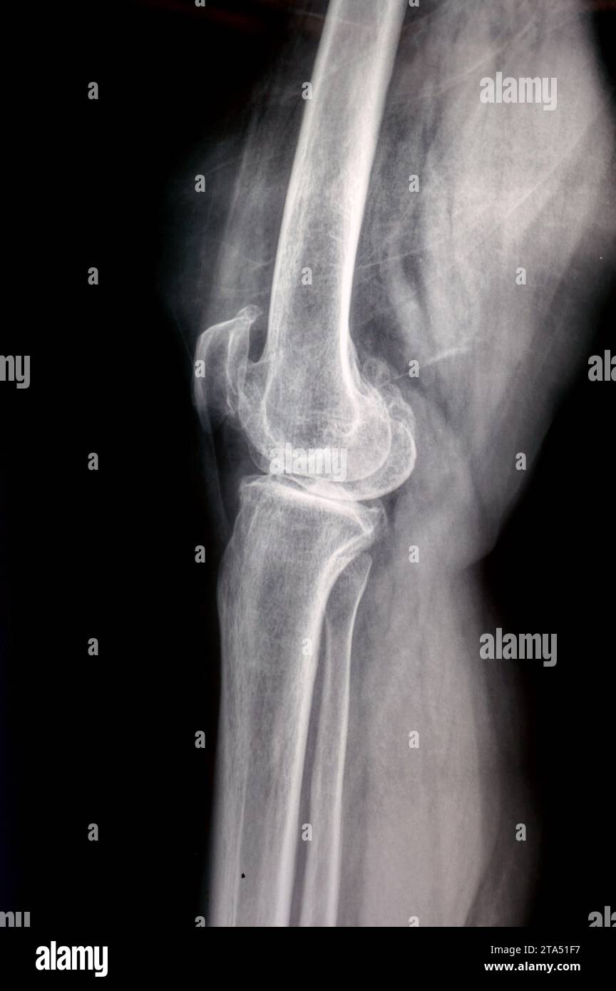 Plain X ray of the right knee shows apparent joint osteoarthritis ...