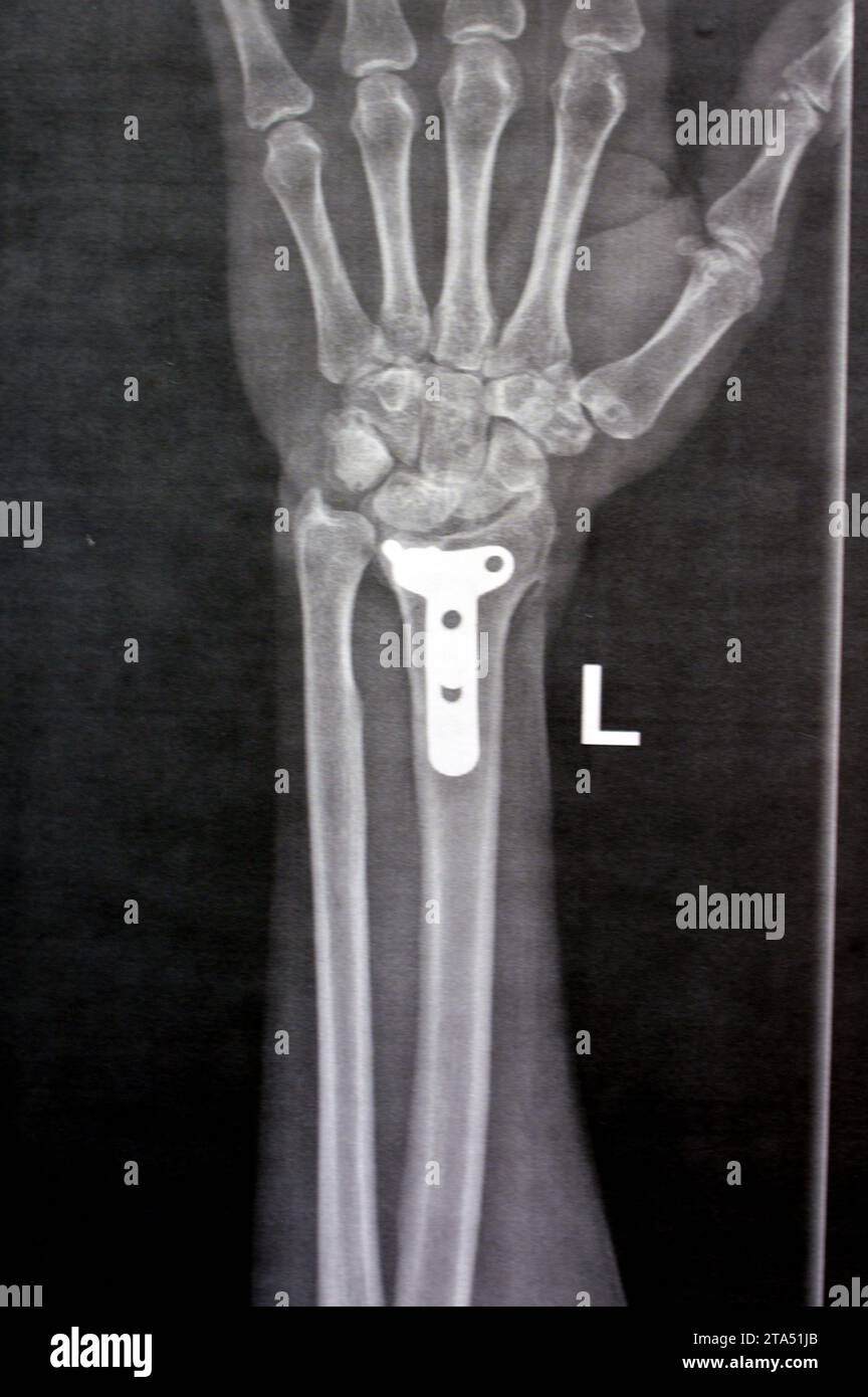 Plain x ray showing a recent fissure fracture at the lower part of a ...