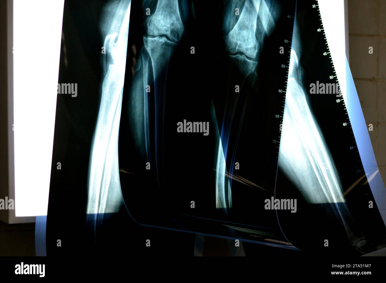 Plain X ray rolls of a medical case before total knee replacement ...