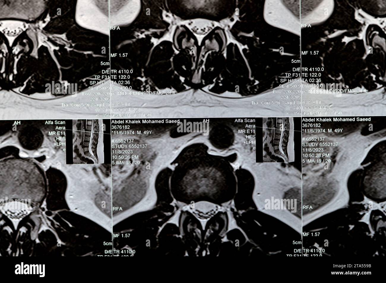 Cairo, Egypt, November 14 2023: MRI of lumbosacral spine revealed L3-L4 ...